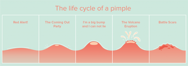 The faults in our skin. Acne? Yes, acne! - By Nua