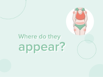 Community Asks: The science behind stretch marks - In Sync By Nua.